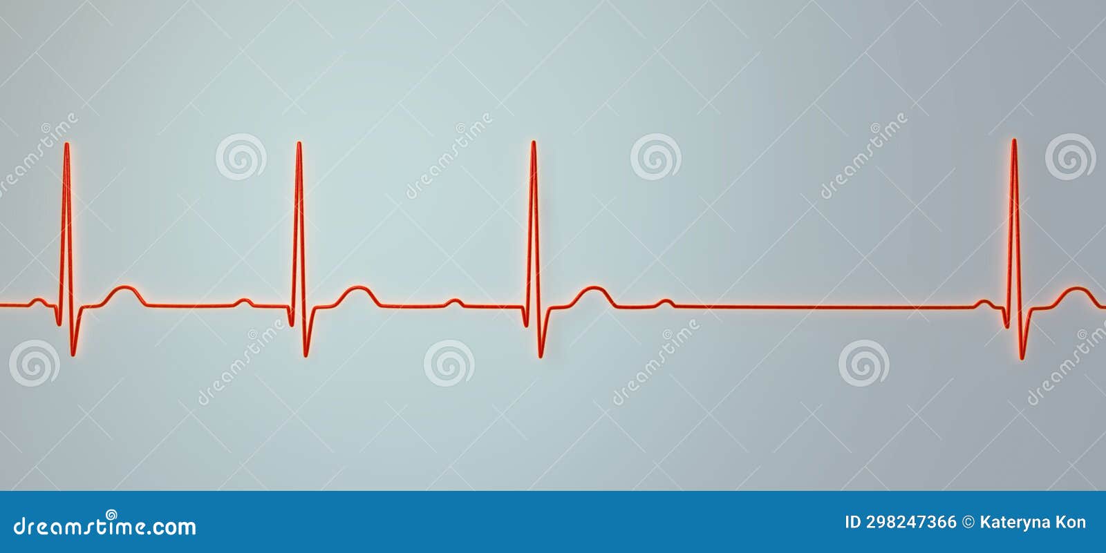 An ECG With 2nd Degree AV Block, 3D Illustration Royalty-Free Cartoon ...