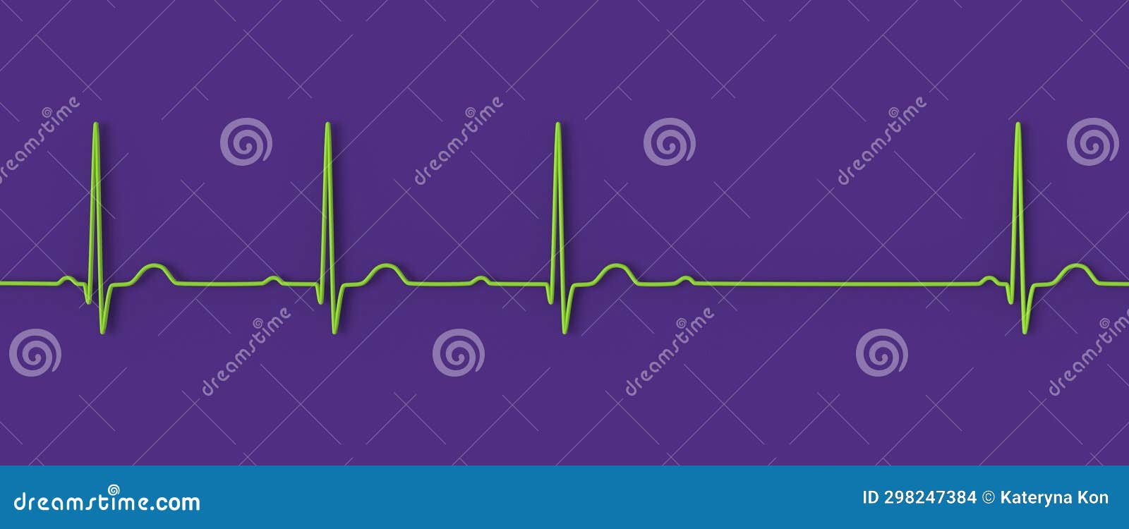 An ECG With 2nd Degree AV Block, 3D Illustration Royalty-Free Cartoon ...