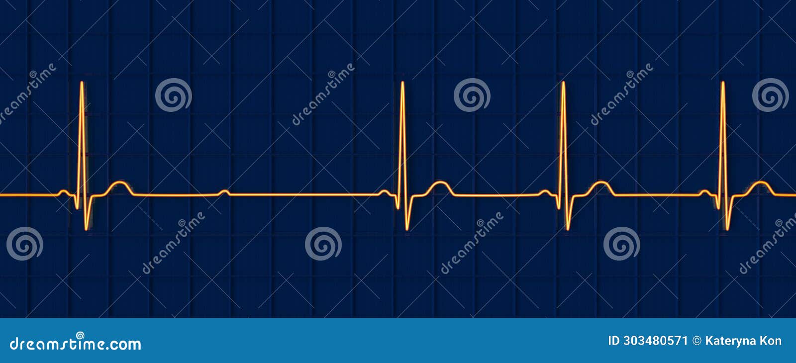 An ECG With 2nd Degree Mobitz 2 AV Block, 3D Illustration Royalty-Free ...