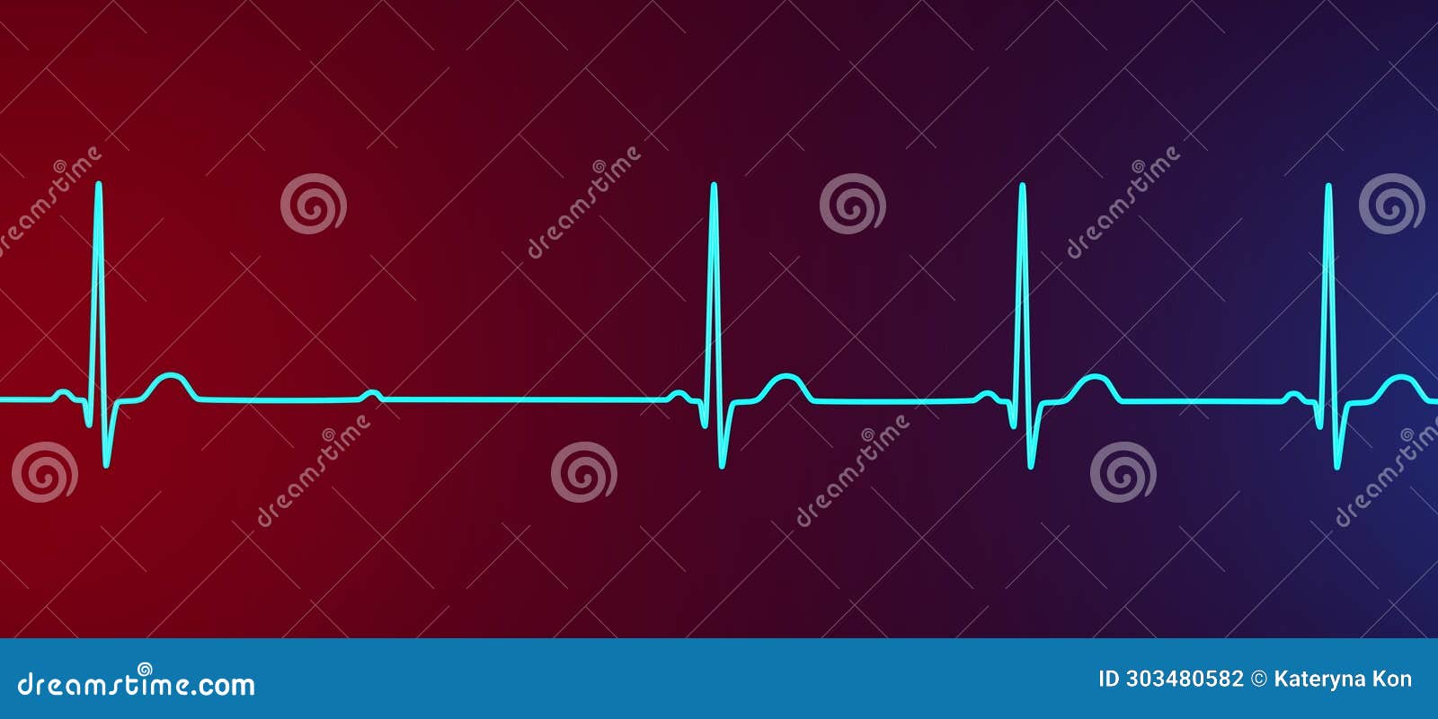 An ECG with 2nd Degree Mobitz 2 AV Block, 3D Illustration Stock ...