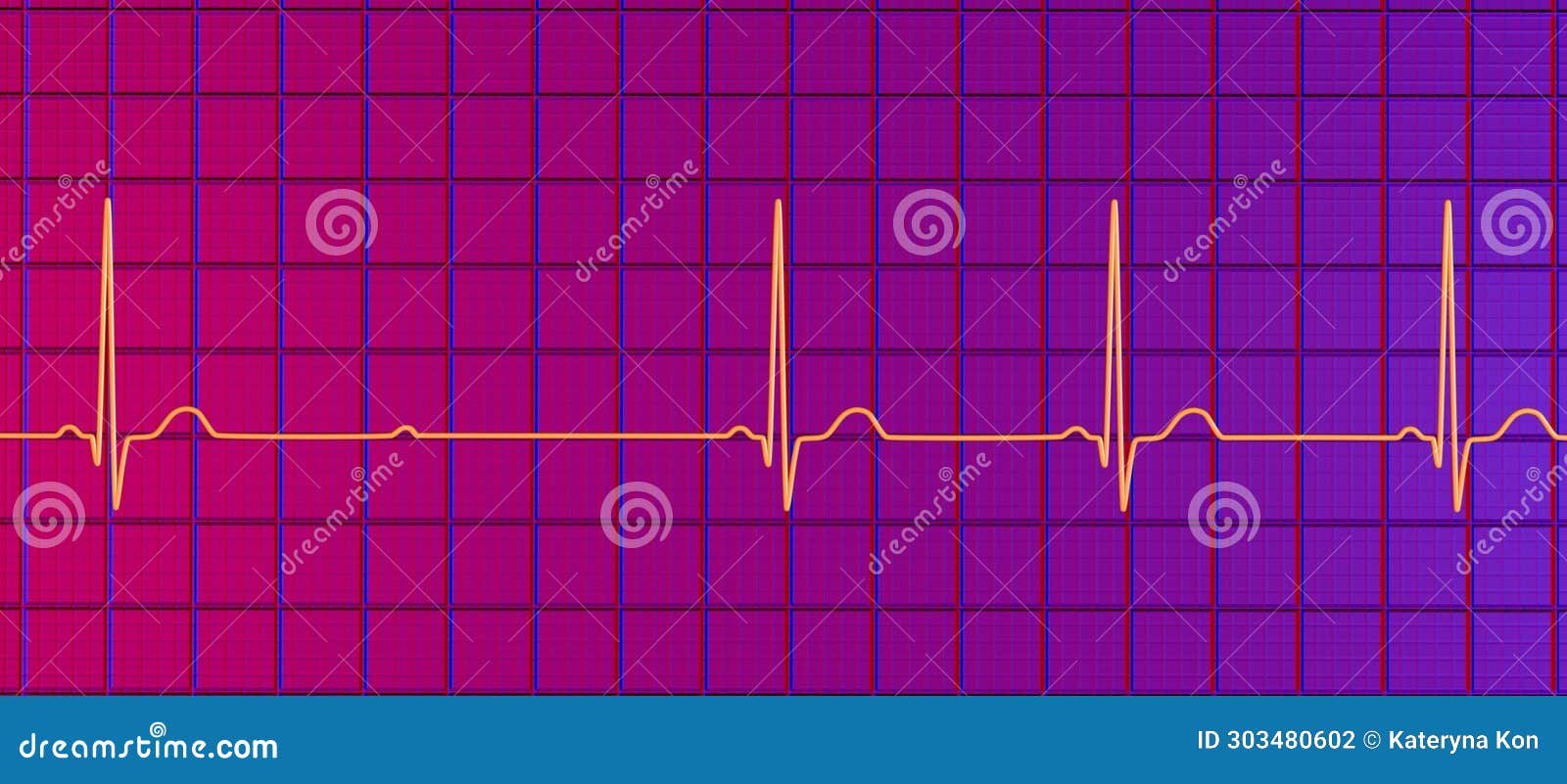 An ECG with 2nd Degree Mobitz 2 AV Block, 3D Illustration Stock ...