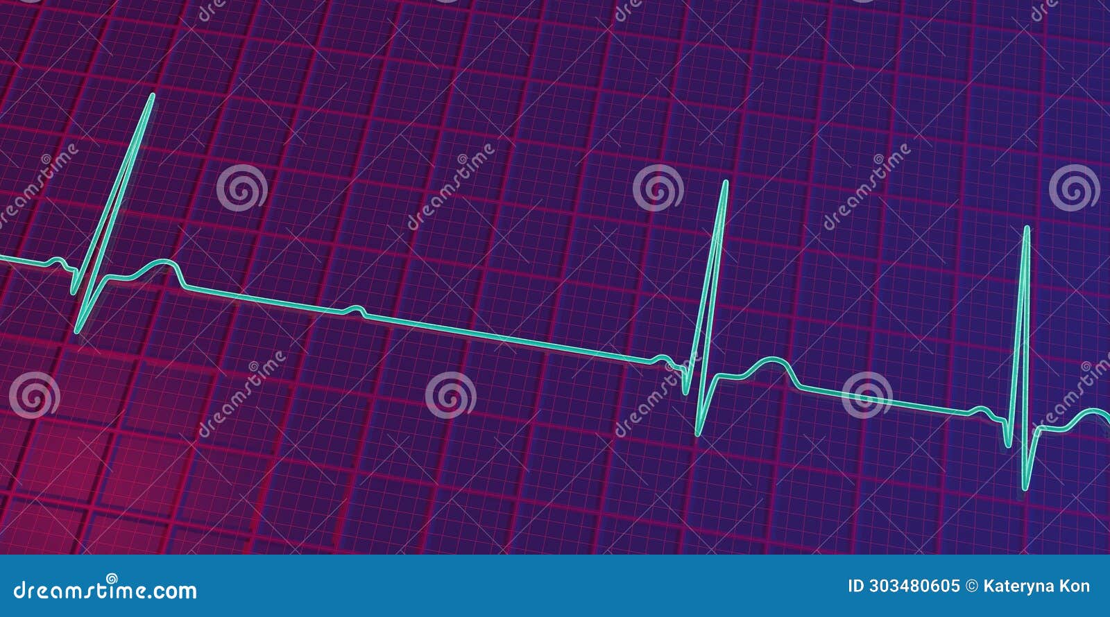 An ECG With 2nd Degree Mobitz 2 AV Block, 3D Illustration Royalty-Free ...