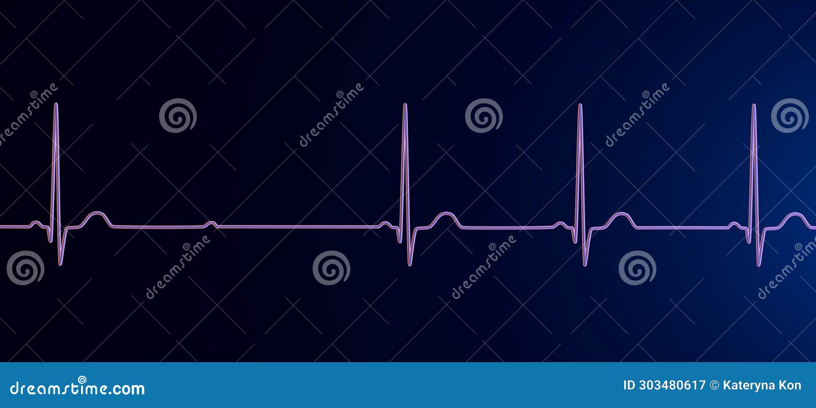 An ECG With 2nd Degree Mobitz 2 AV Block, 3D Illustration Royalty-Free ...