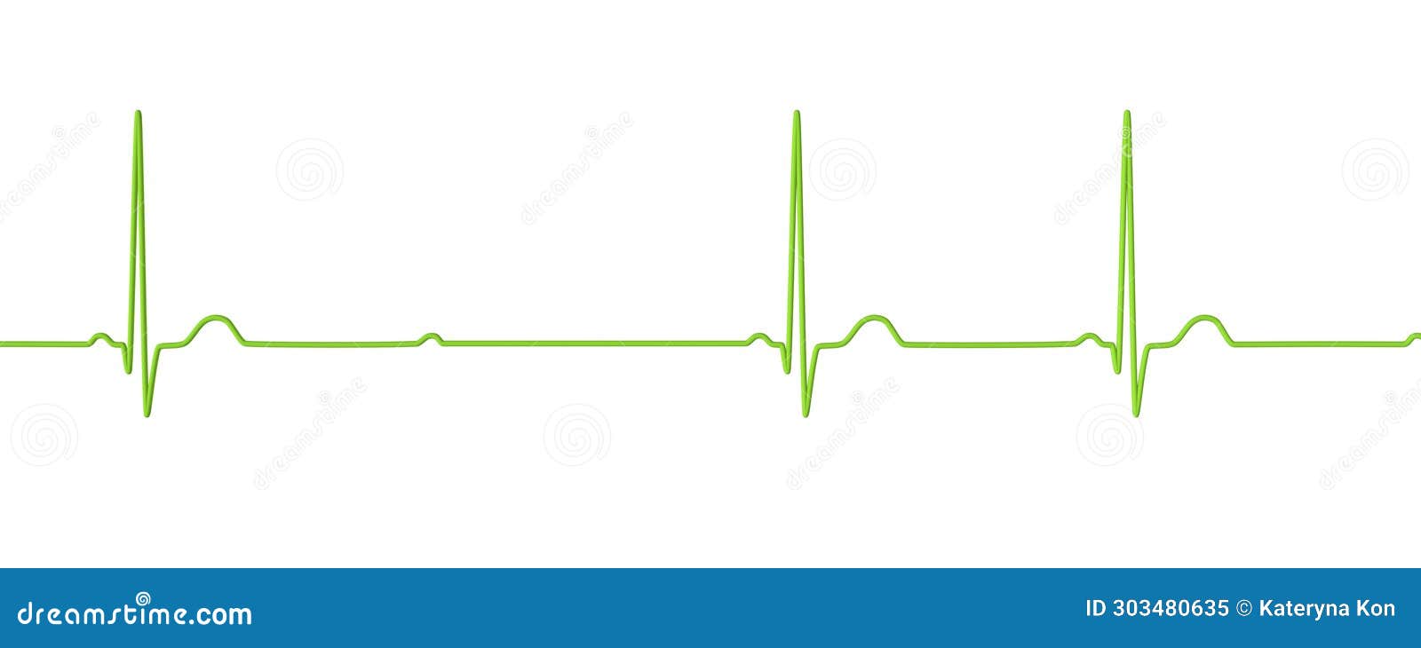An ECG With 2nd Degree Mobitz 2 AV Block, 3D Illustration Royalty-Free ... An ECG With 2nd Degree Mobitz 2 AV Block, 3D Illustration Royalty-Free ...