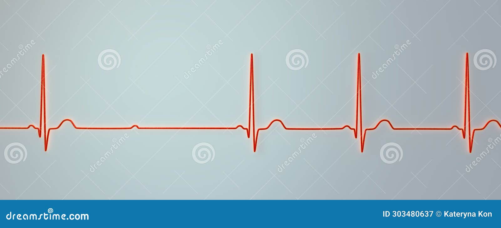 An ECG With 2nd Degree Mobitz 2 AV Block, 3D Illustration Royalty-Free ...