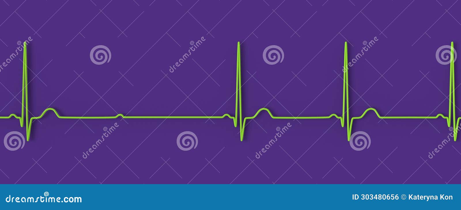 An ECG With 2nd Degree Mobitz 2 AV Block, 3D Illustration Royalty-Free ...