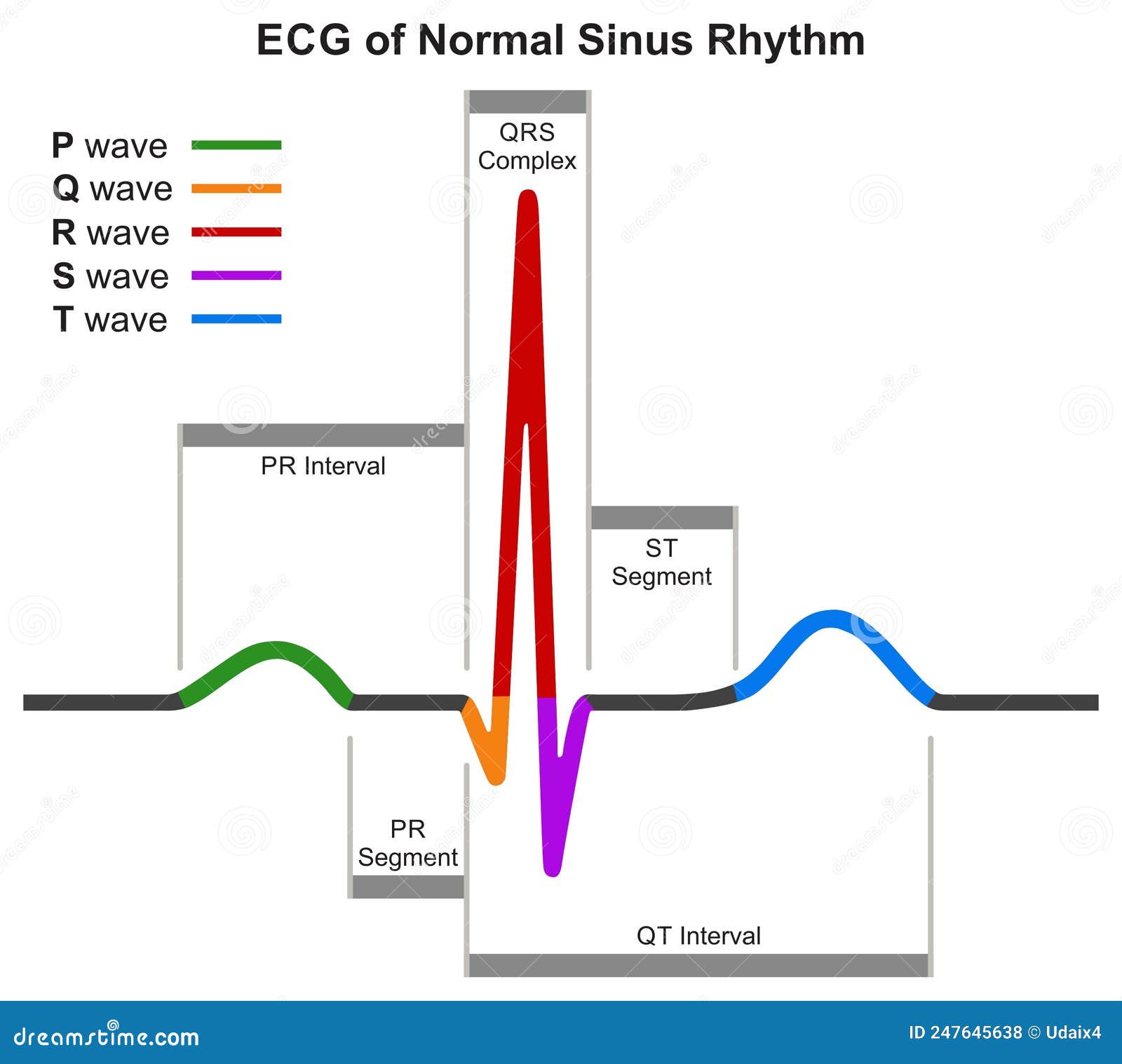 ECG of Normal Sinus Rhythm Infographic Diagram Stock Vector ... ECG of Normal Sinus Rhythm Infographic Diagram Stock Vector ...