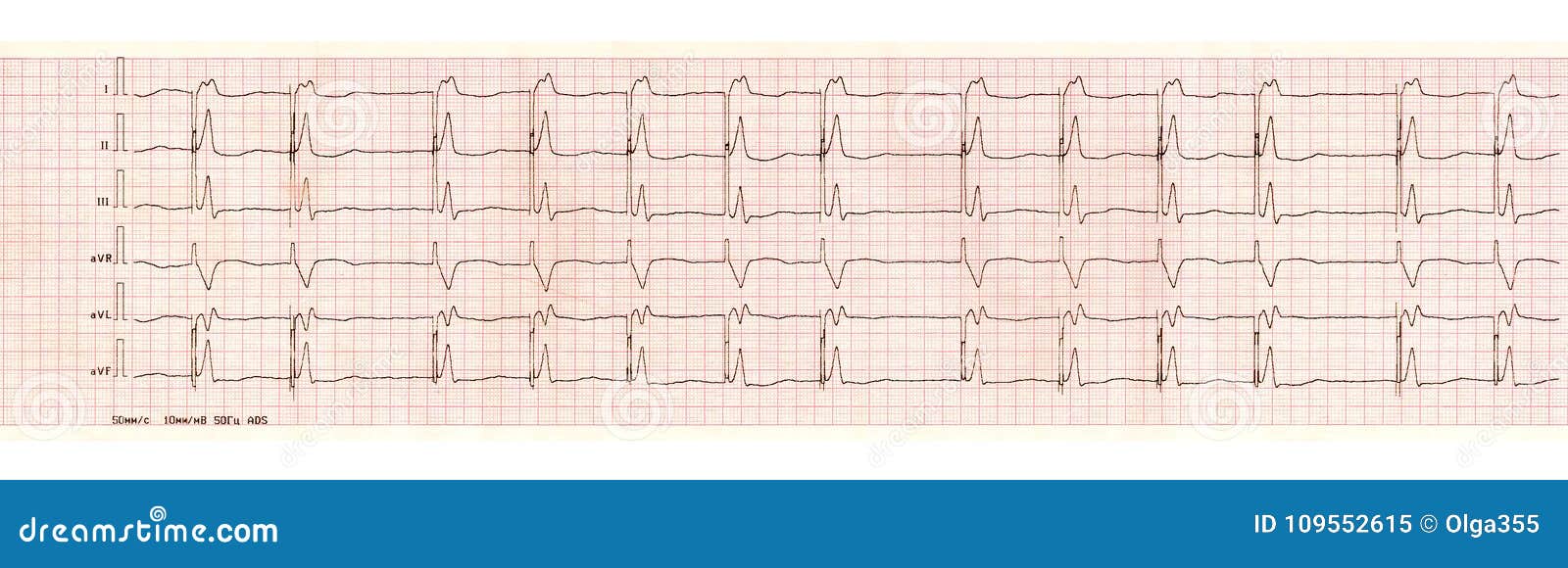 ECG with Pacemaker Arrhythmia Ventricular Stimulation Stock Image ...