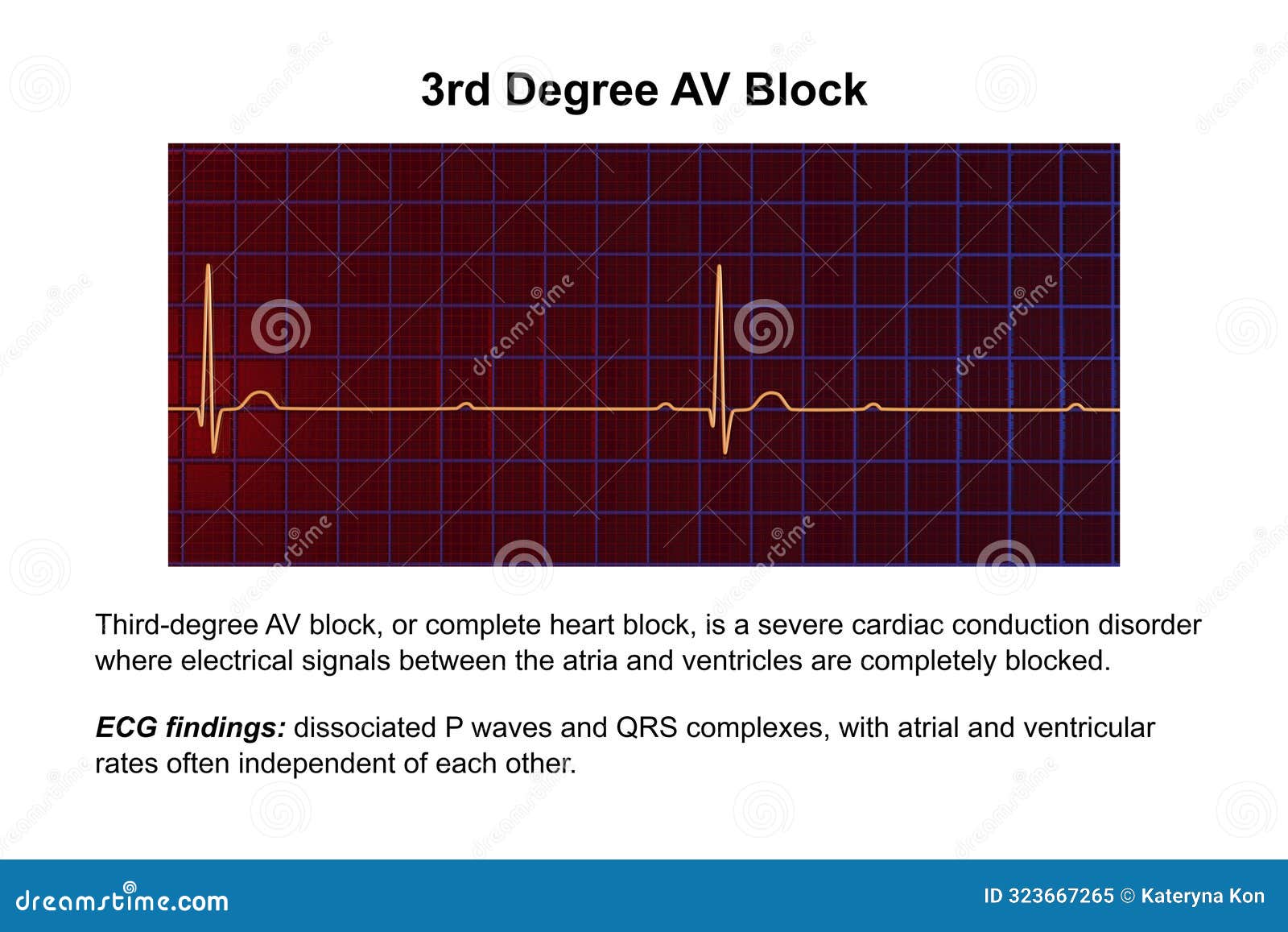 Ecg Of 3rd Degree Av Block 3d Illustration 323667265