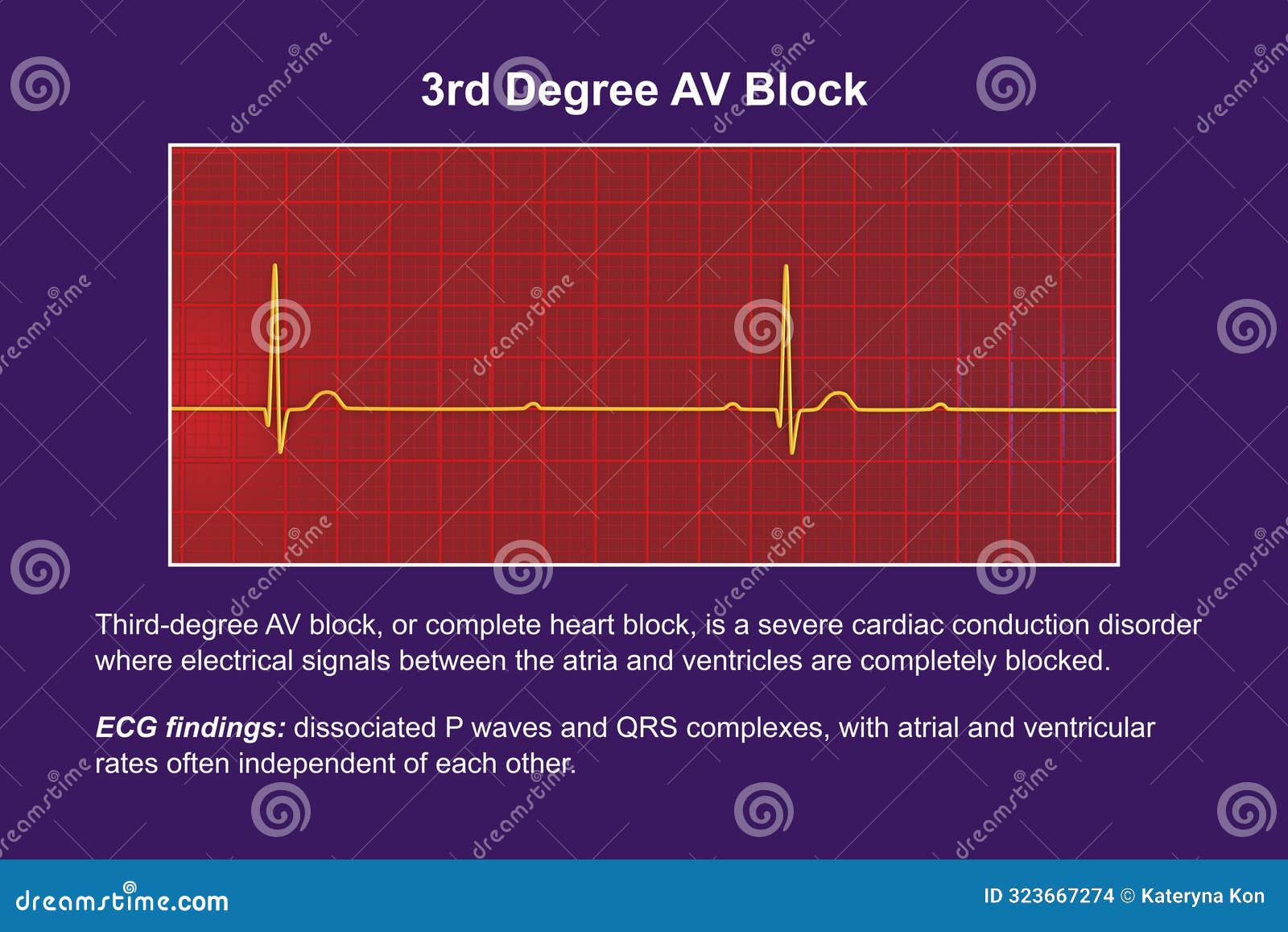 ECG Of 3rd Degree AV Block, 3D Illustration | CartoonDealer.com #323667274