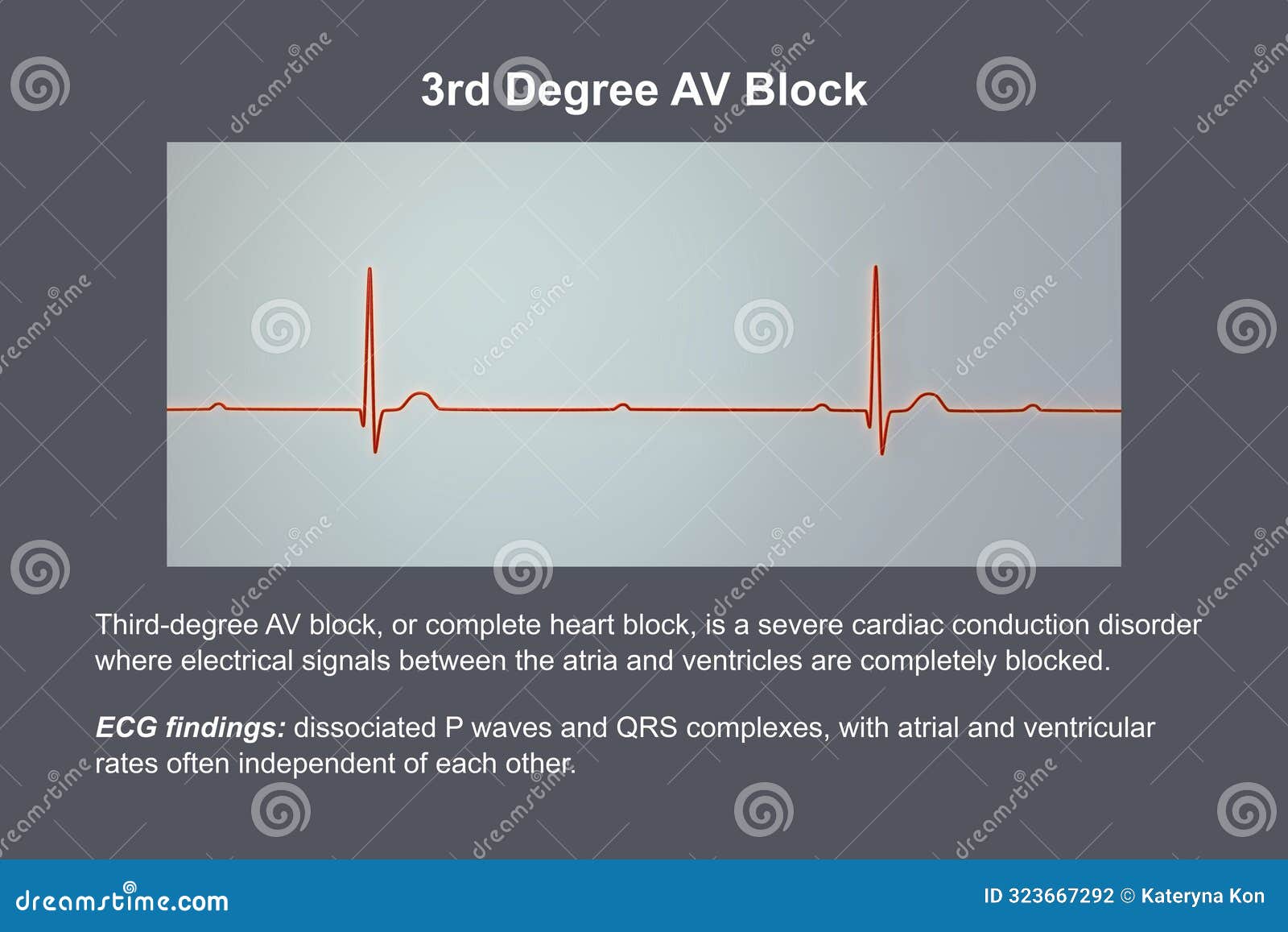 ECG Of 3rd Degree AV Block, 3D Illustration | CartoonDealer.com #323667292