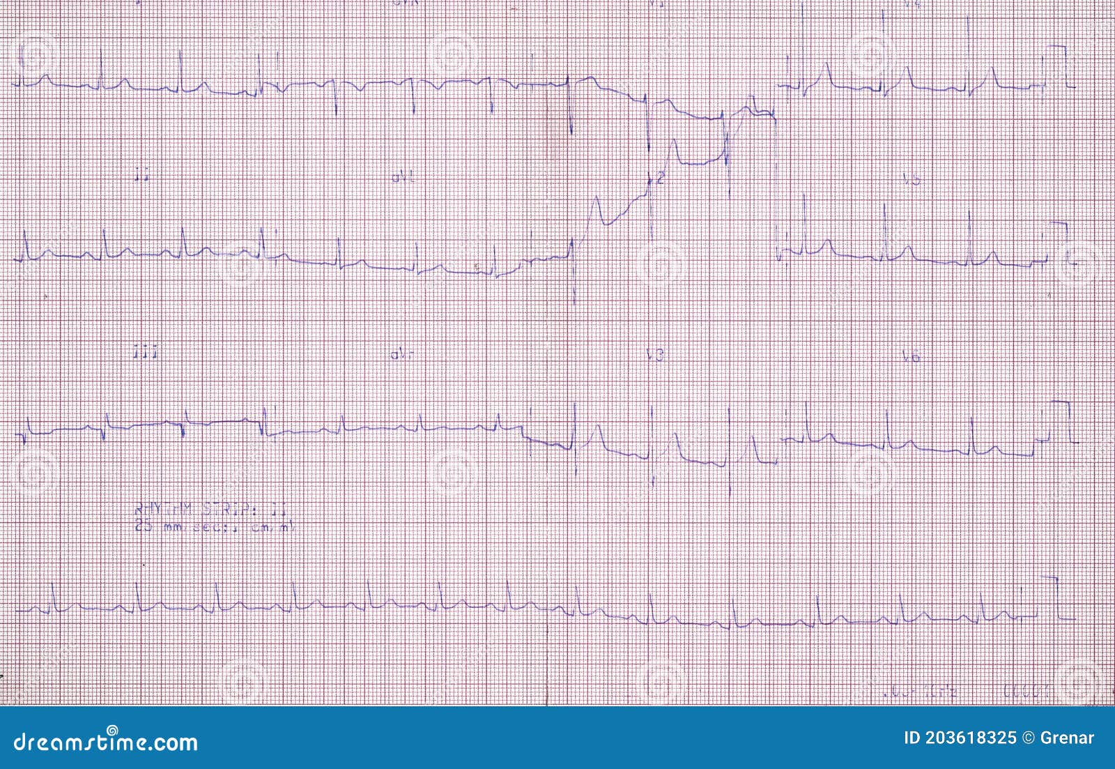 A Real Chart Of An ECG. Electrocardiogram Registered On Paper. Heart`s ...