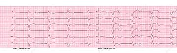 ECG with Rhythm of Artificial Pacemaker Ventricular Pacing Stock Image ...