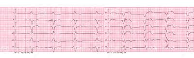 ECG with Rhythm of Artificial Pacemaker Ventricular Pacing Stock Image ...