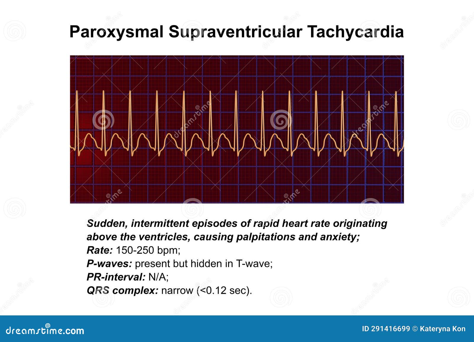 ECG in Supraventricular Tachycardia, 3D Illustration Stock Illustration ...