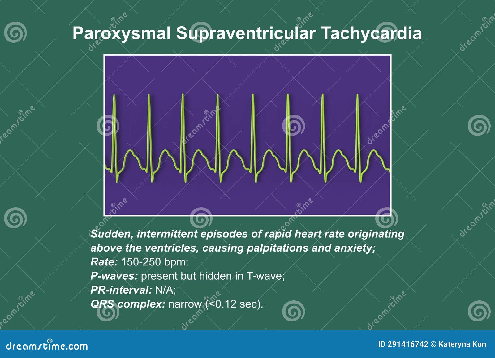 ECG in Supraventricular Tachycardia, 3D Illustration Stock Illustration ...
