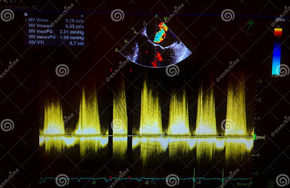 Echocardiogram Colorful Probe Targeting Map and Waveforms Stock Photo ...