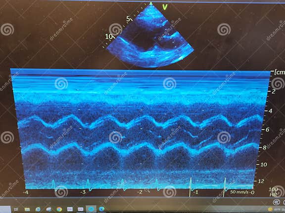 Echocardiogram Colorful Probe Targeting Map and Waveforms Stock Image ...