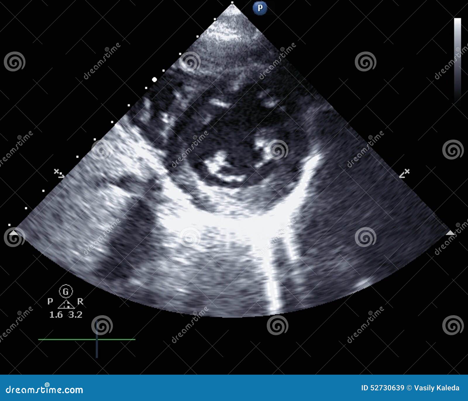 Echocardiogram stock image. Image of hypertension, patient - 52730639 Echocardiogram stock image. Image of hypertension, patient - 52730639