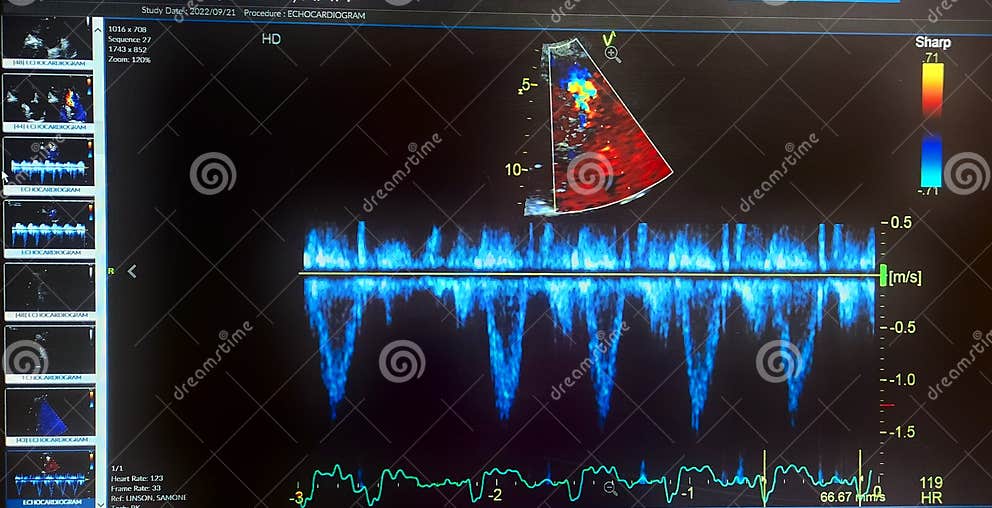 Echocardiogram Colorful Probe Targeting Map and Waveforms Stock Image ...