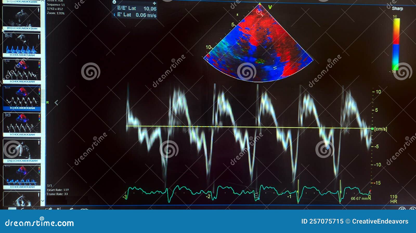 Echocardiogram Colorful Probe Targeting Map and Waveforms Stock Image ...