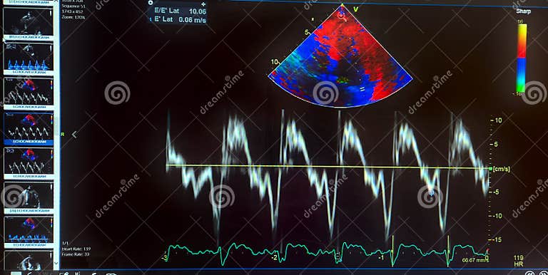 Echocardiogram Colorful Probe Targeting Map and Waveforms Stock Image ...