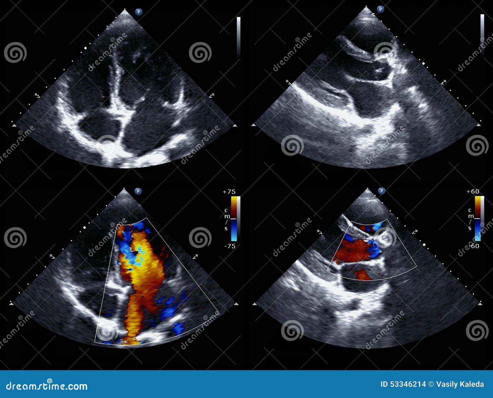 Doppler Echocardiography Stock Image | CartoonDealer.com #52734871