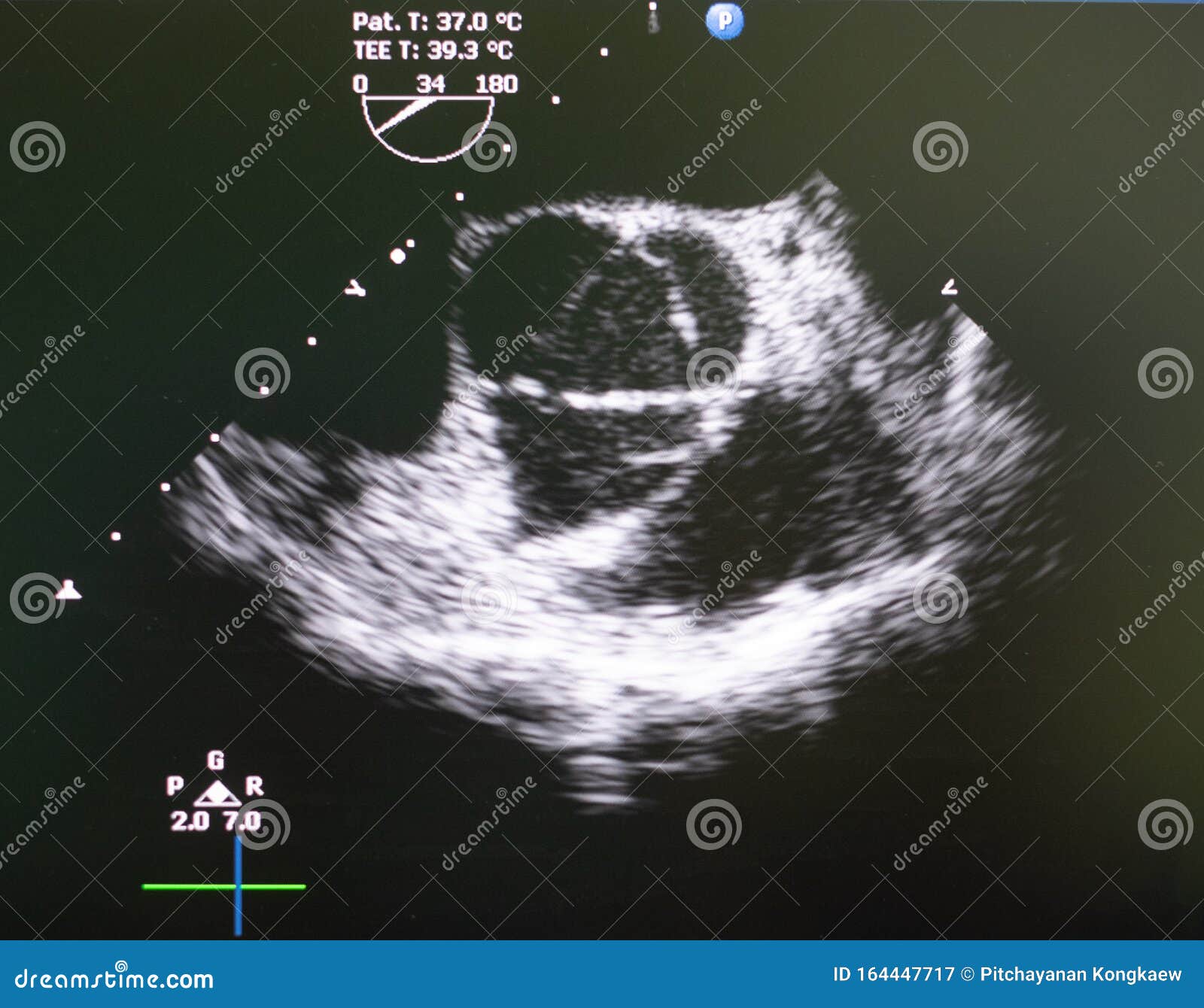 Echocardiography Ultrasound Machine.2D Aortic Valve Echocardiography ...