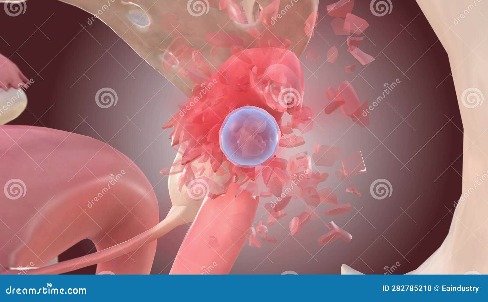 Ectopic Pregnancy Embryo Causes Tube Rupture Stock Footage - Video of ...