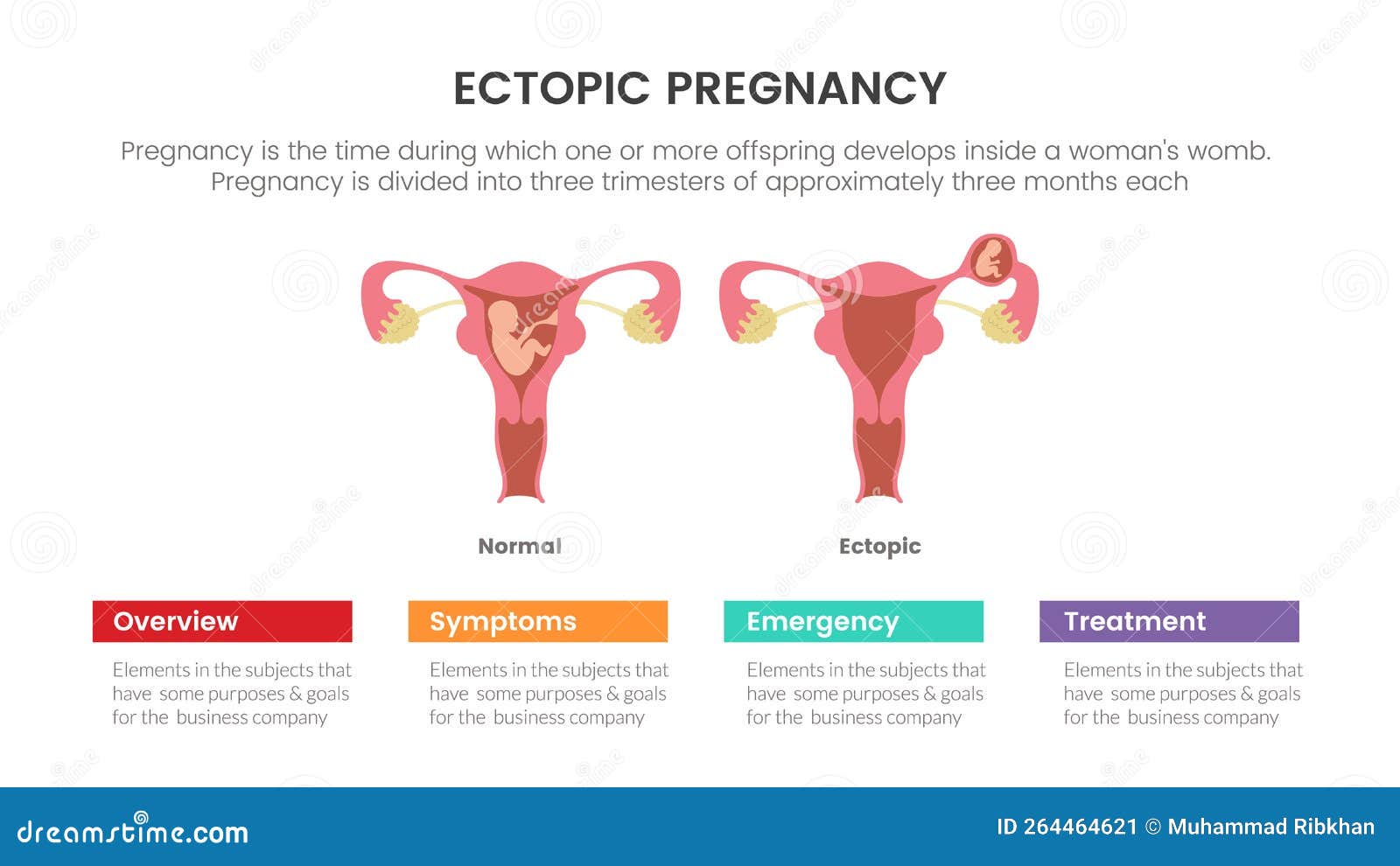 Ectopic Pregnant Or Pregnancy Infographic Concept For Slide