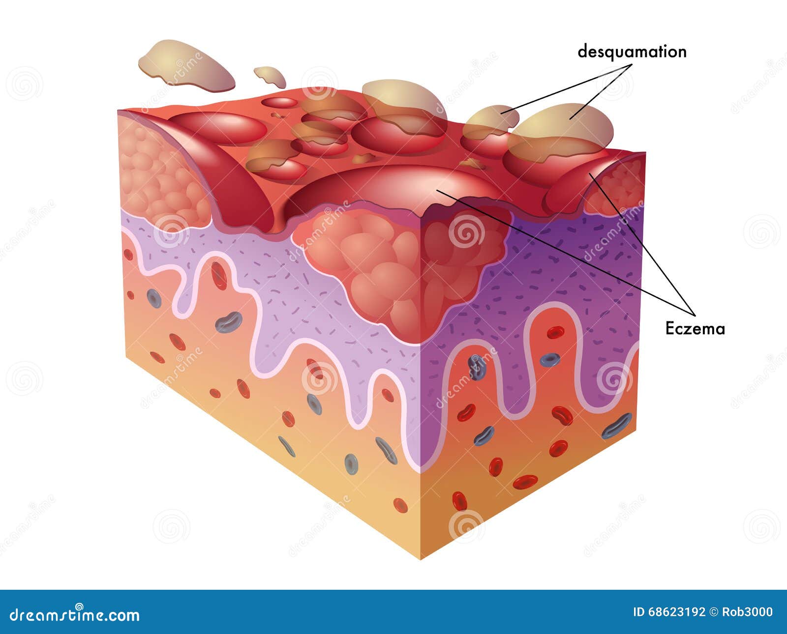 Eczéma Stock Illustrations, Vecteurs, & Clipart – (1,581 Stock ...
