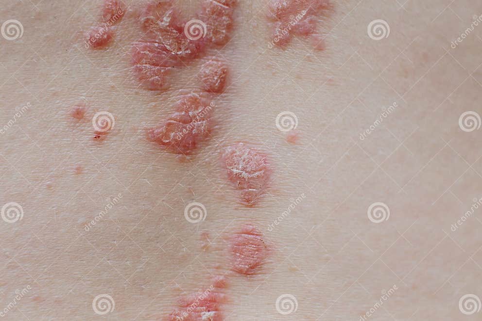 Eczema Atopic Dermatitis Symptom Skin Detail Texture Psoriasis Spots