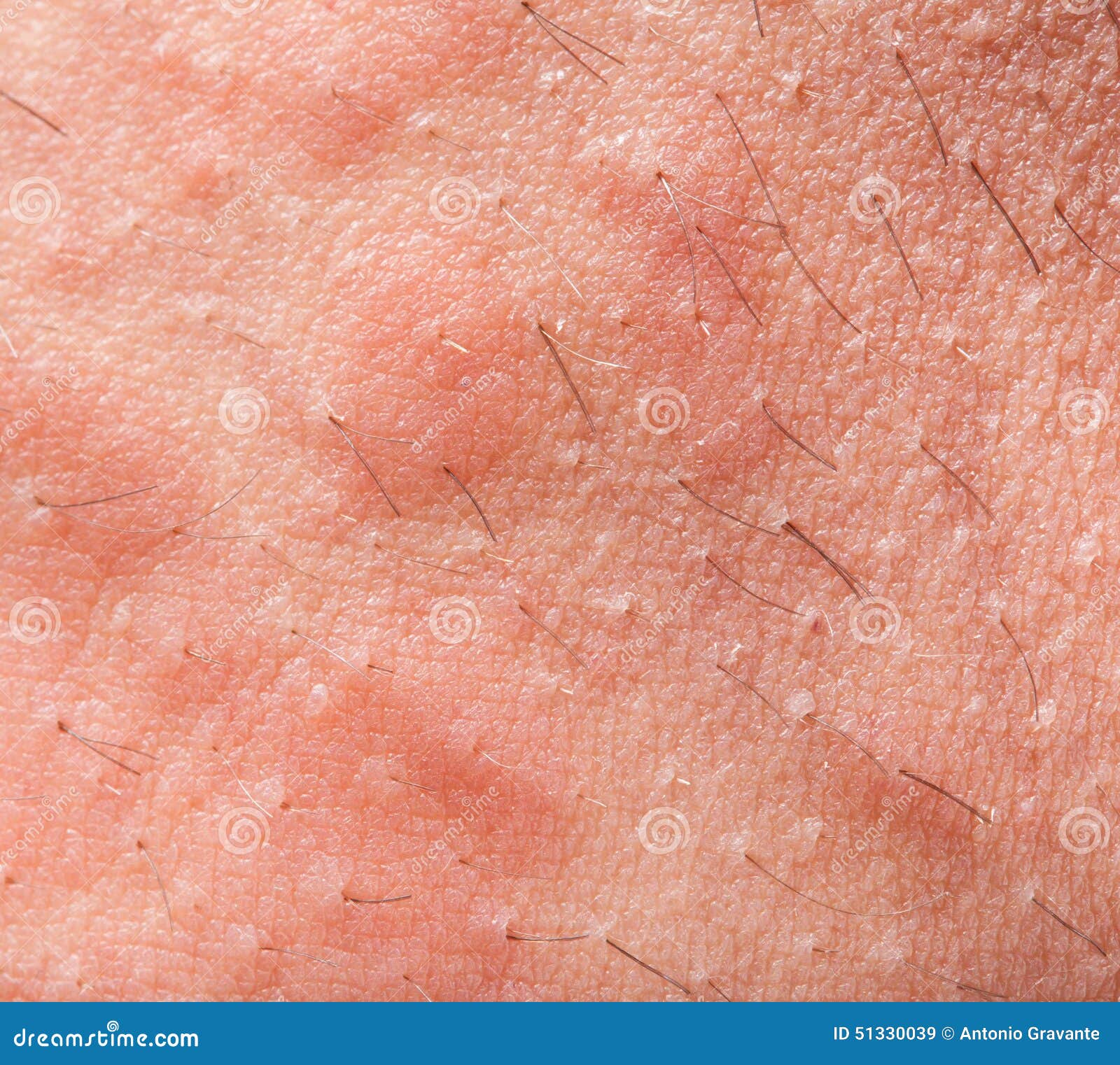 Eczema Atopic Dermatitis Symptom Skin Texture Royalty-Free Stock Photo ...
