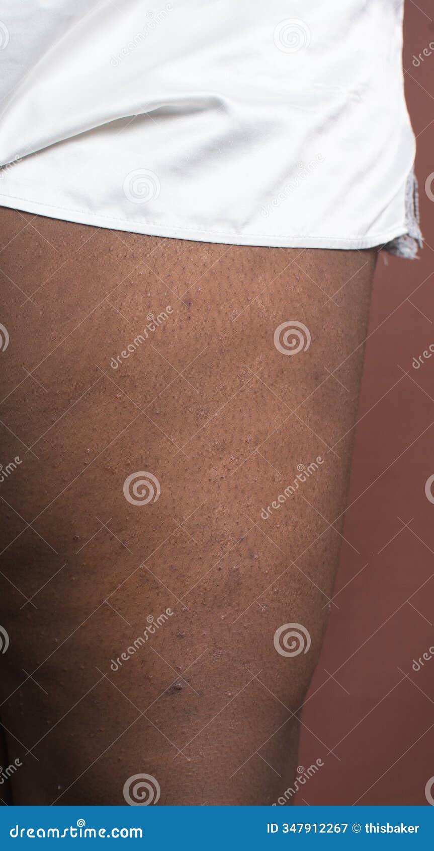 Brown Skin with Hyperpigmentation and Scarring from Eczema and Atopic ...