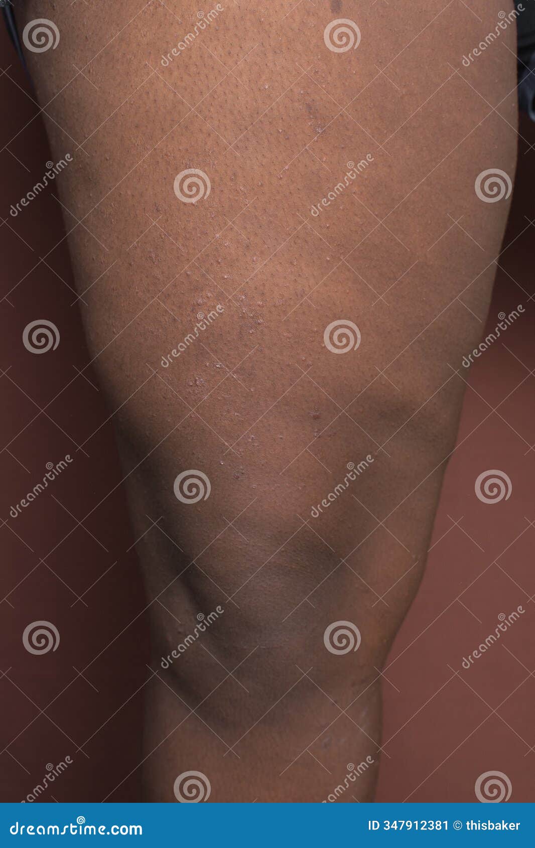 Brown Skin with Hyperpigmentation and Scarring from Eczema and Atopic ...