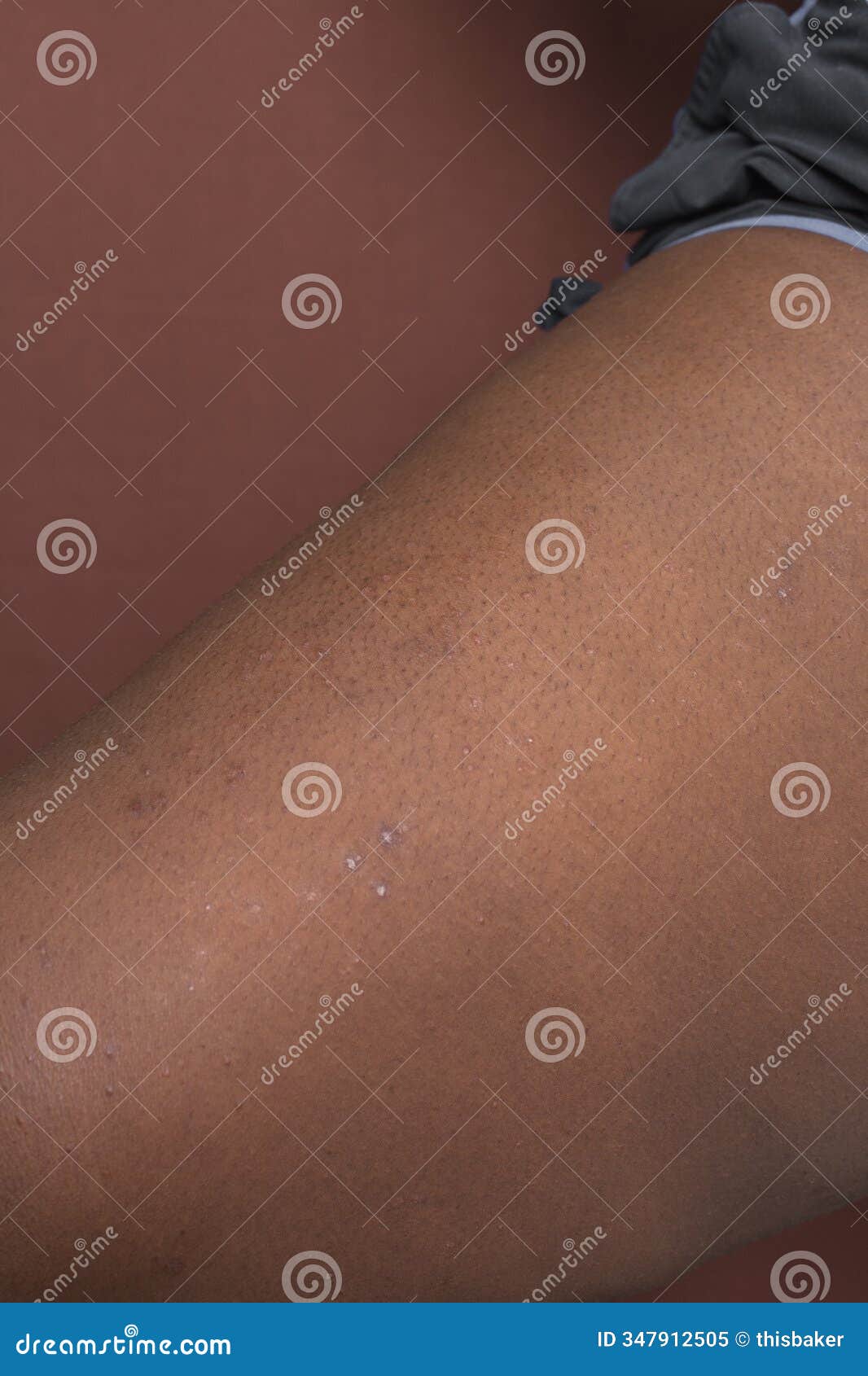 Brown Skin with Hyperpigmentation and Scarring from Eczema and Atopic ...