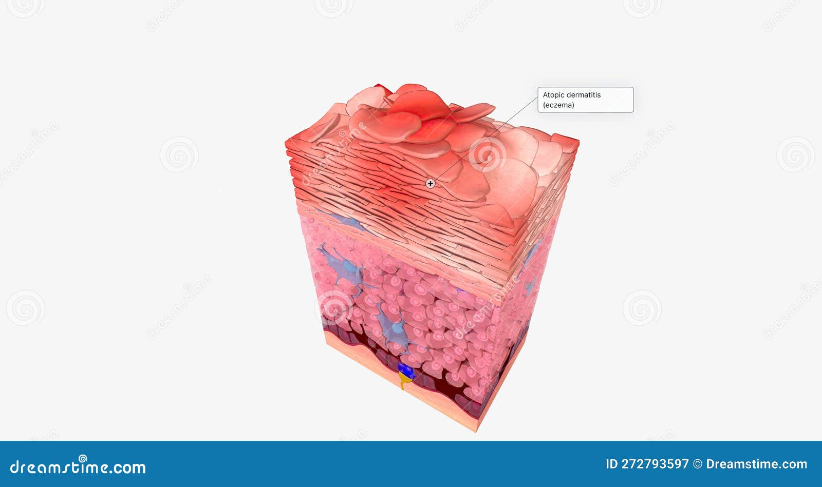 Eczema at the Cellular Level Stock Illustration - Illustration of ...
