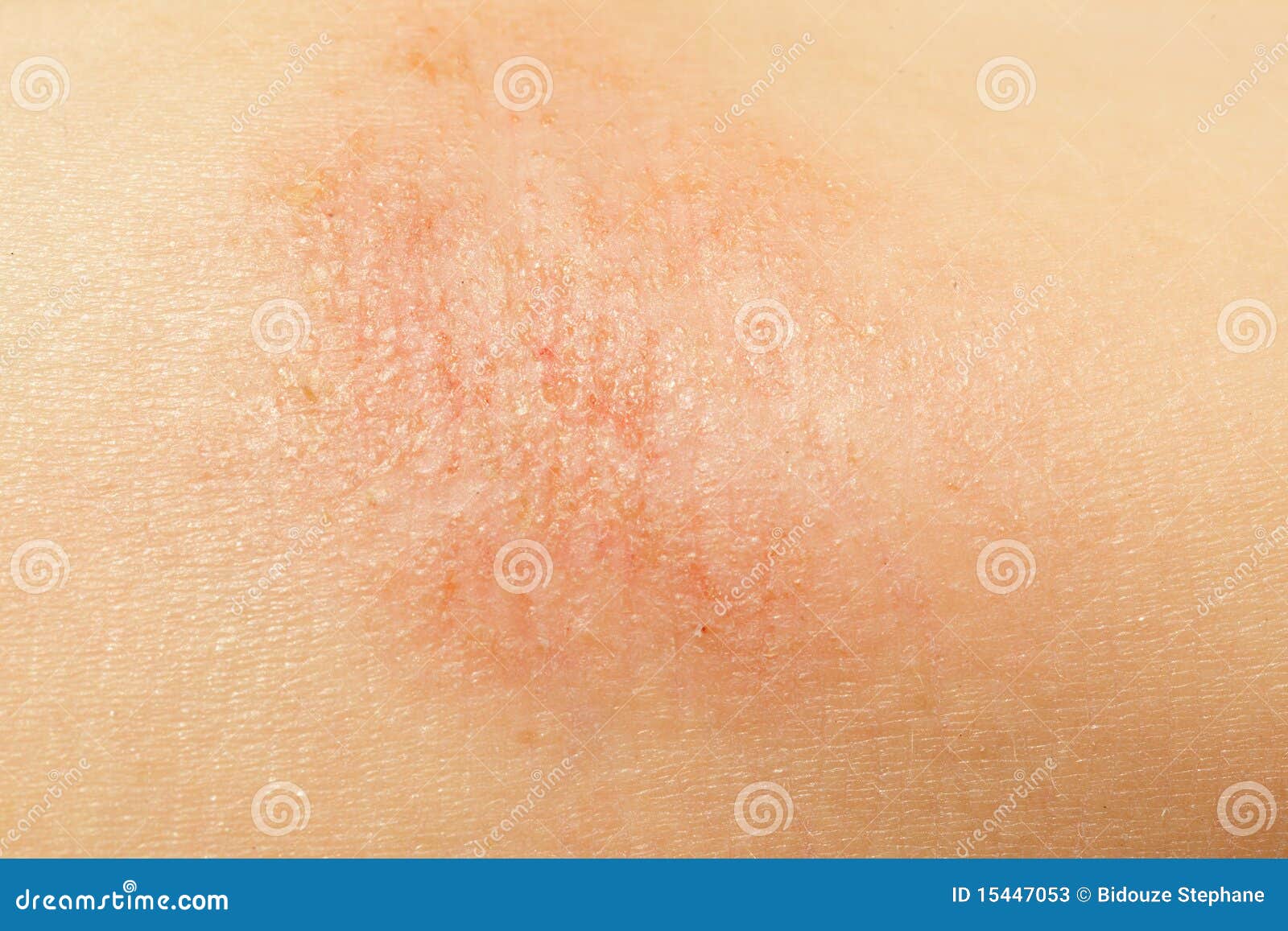 Eczema on child skin stock image. Image of healthcare - 15447053