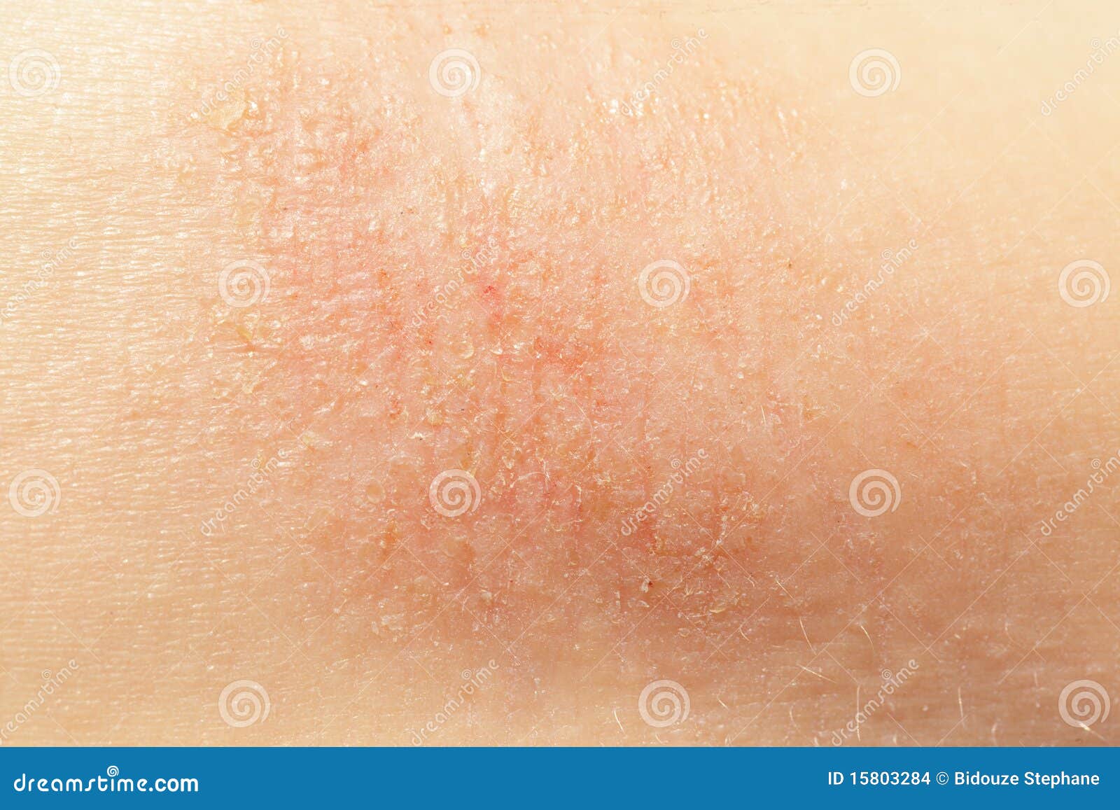 Eczema on child skin stock photo. Image of illness, healthcare - 15803284