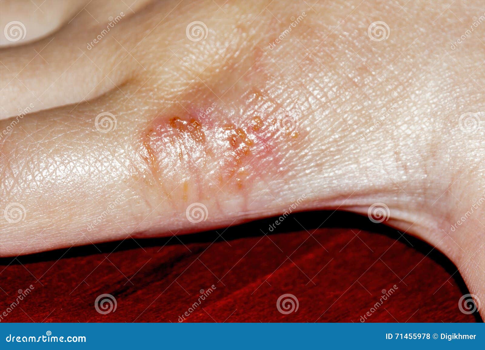 Eczema de la piel foto de archivo. Imagen de gente, dedo - 71455978