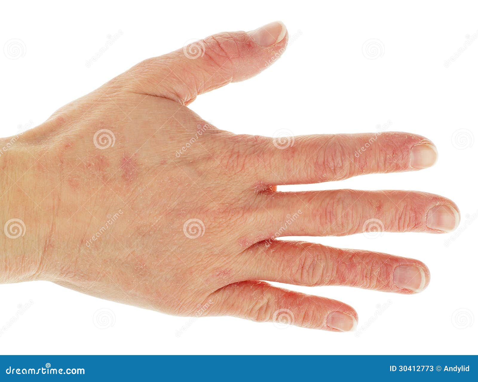 Eczema Dermatitis on Back of Hand Stock Image - Image of back, illness ...