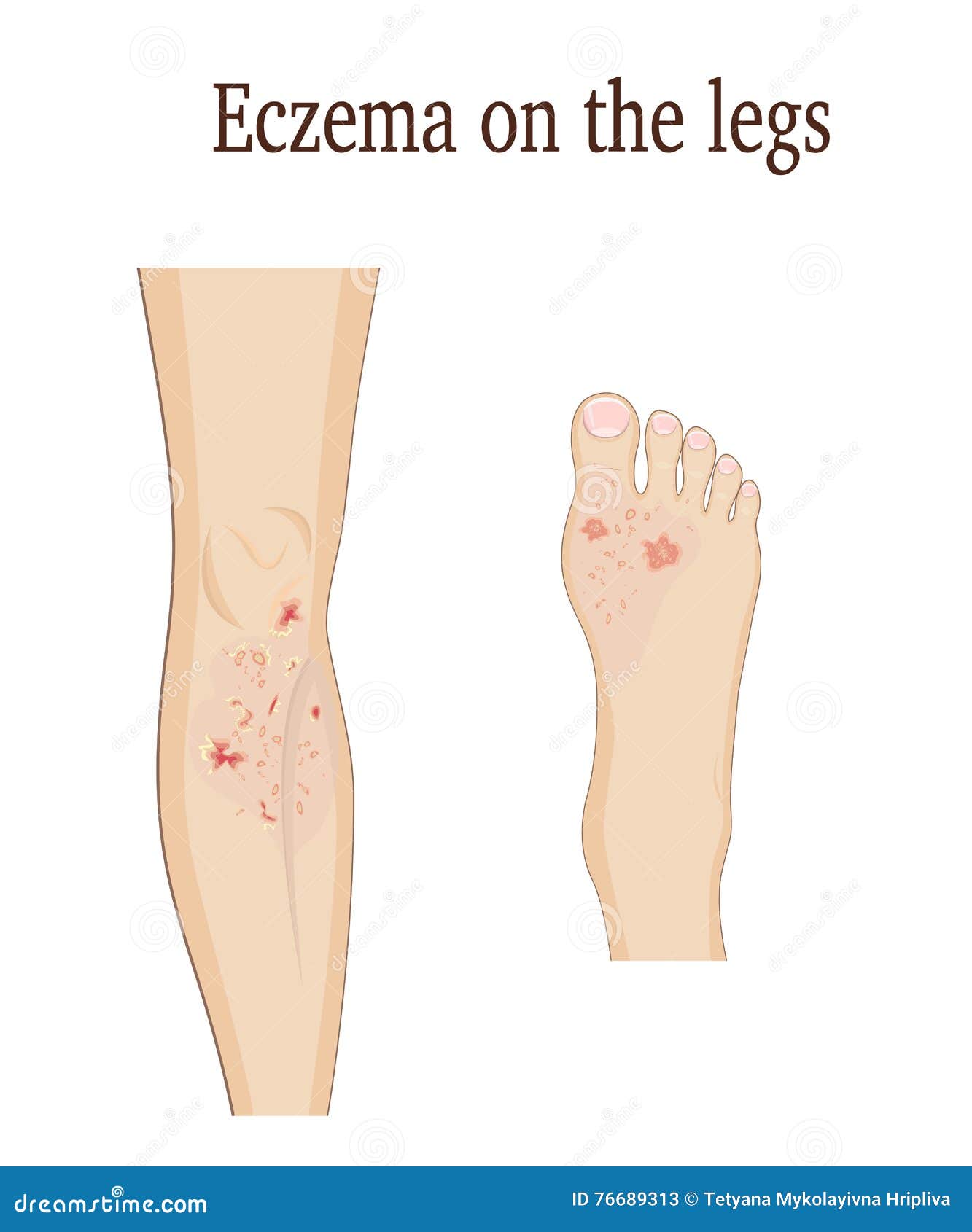 Eczema en las piernas ilustración del vector. Ilustración de peladura ...