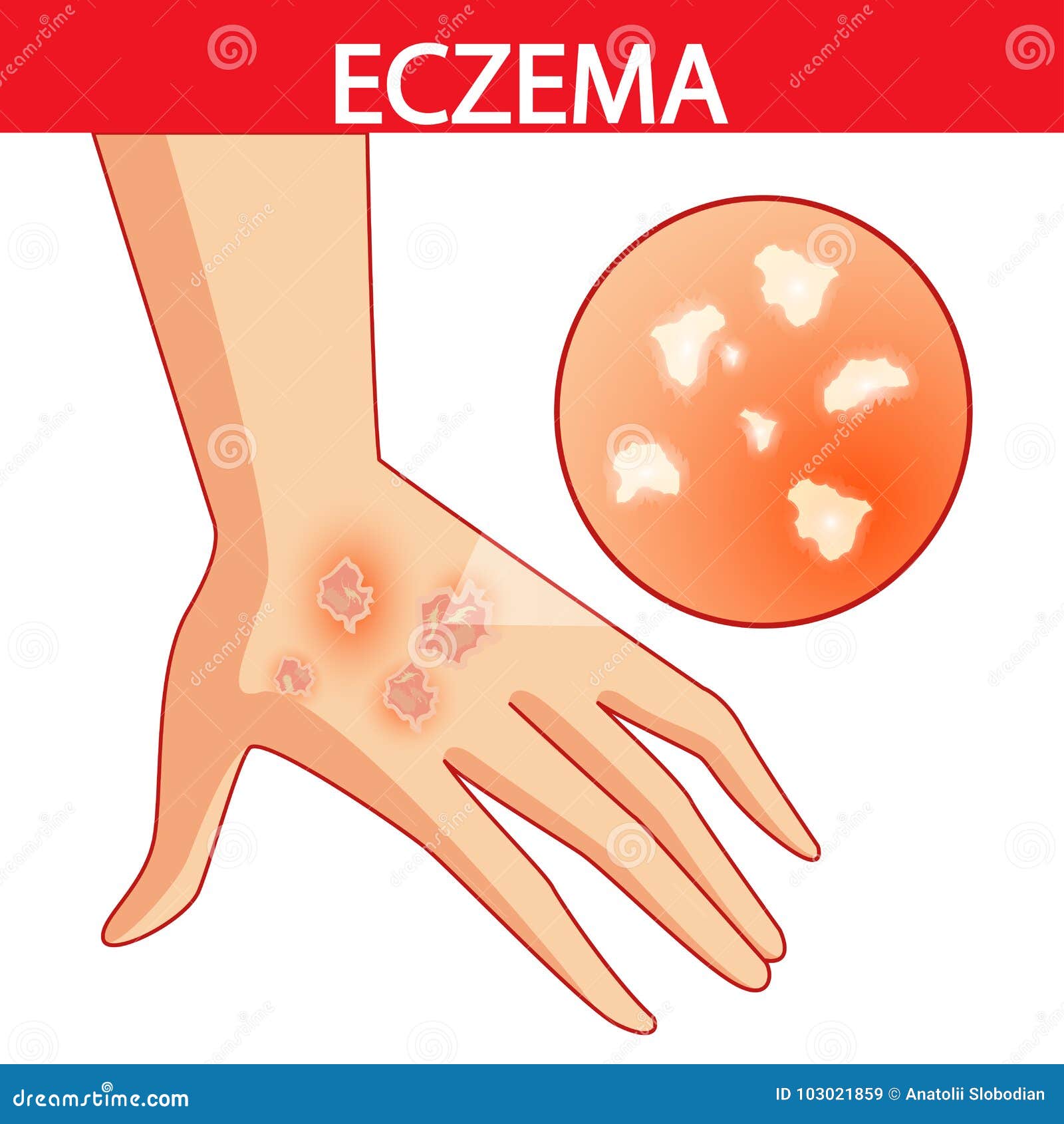 Eczema Of The Hands Psoriasis Dermatitis Dermatology Eczema Skin