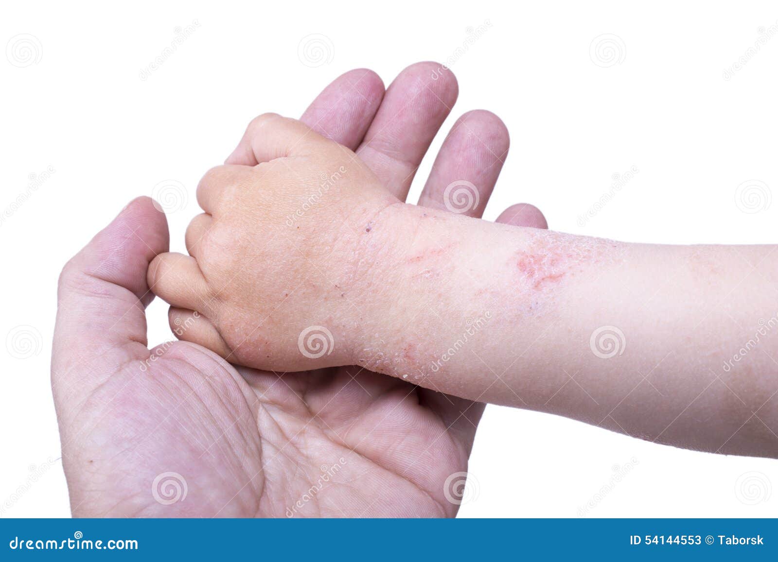 Eczema on the kid s hand stock image. Image of dermatology - 54144553