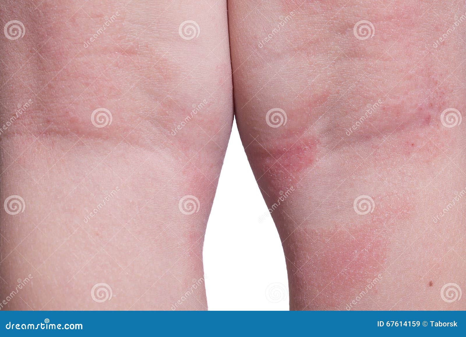 Eczema Kid Legs Photos - Free & Royalty-Free Stock Photos from Dreamstime