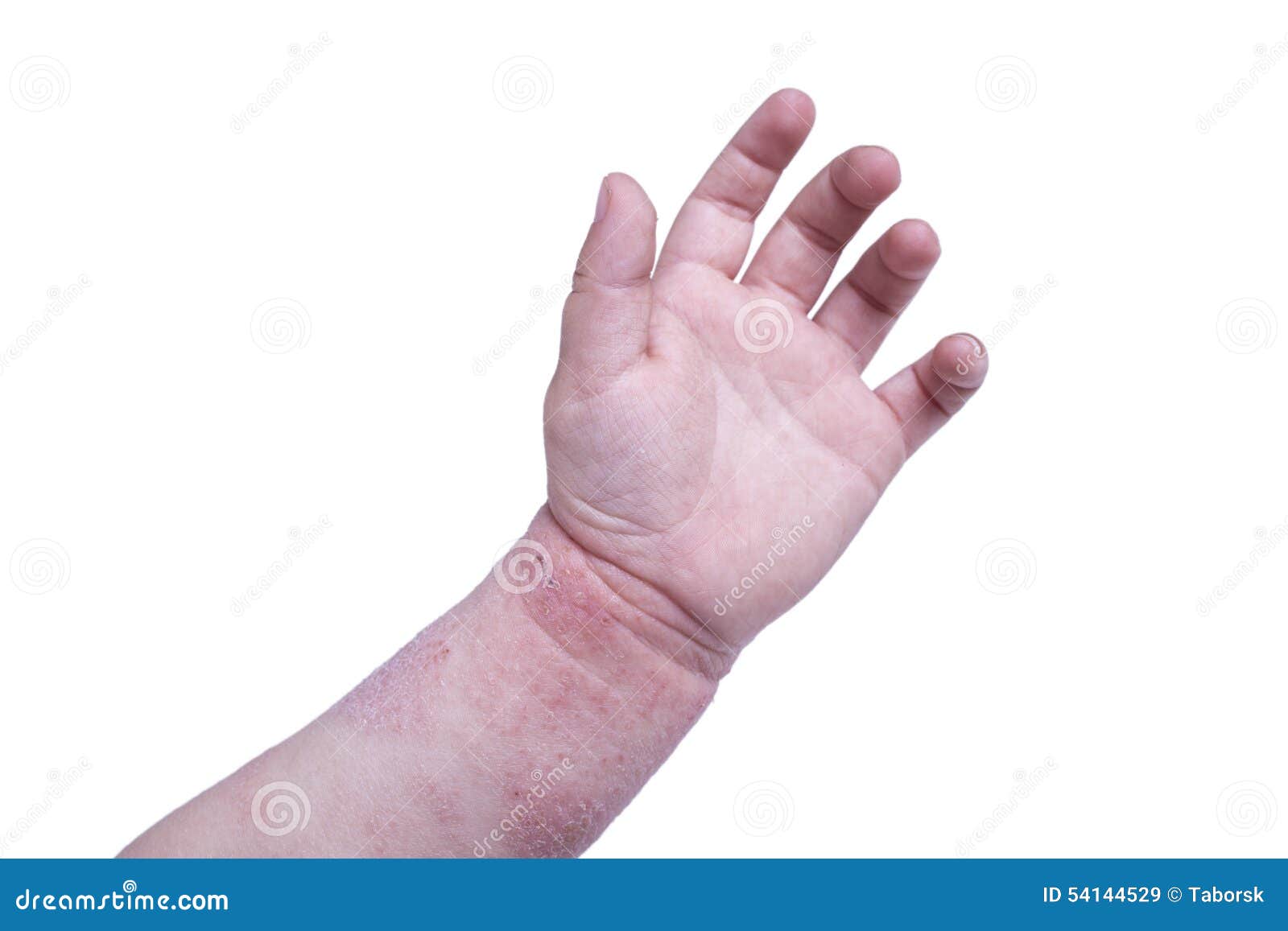 Eczema Op De Hand Van Het Jonge Geitje Stock Afbeelding - Image of ...