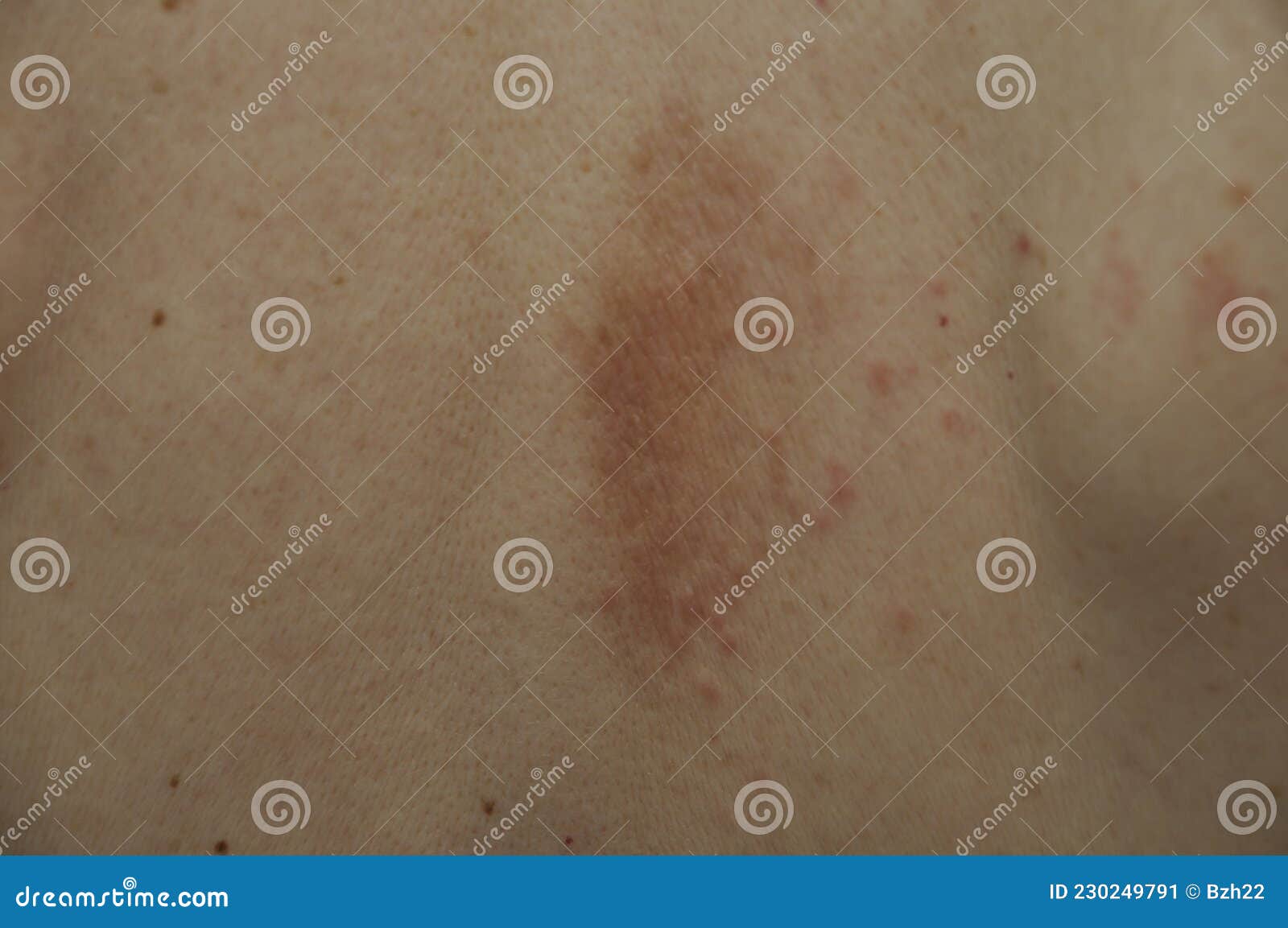 Eczema pimples on a back stock image. Image of epidermal - 230249791