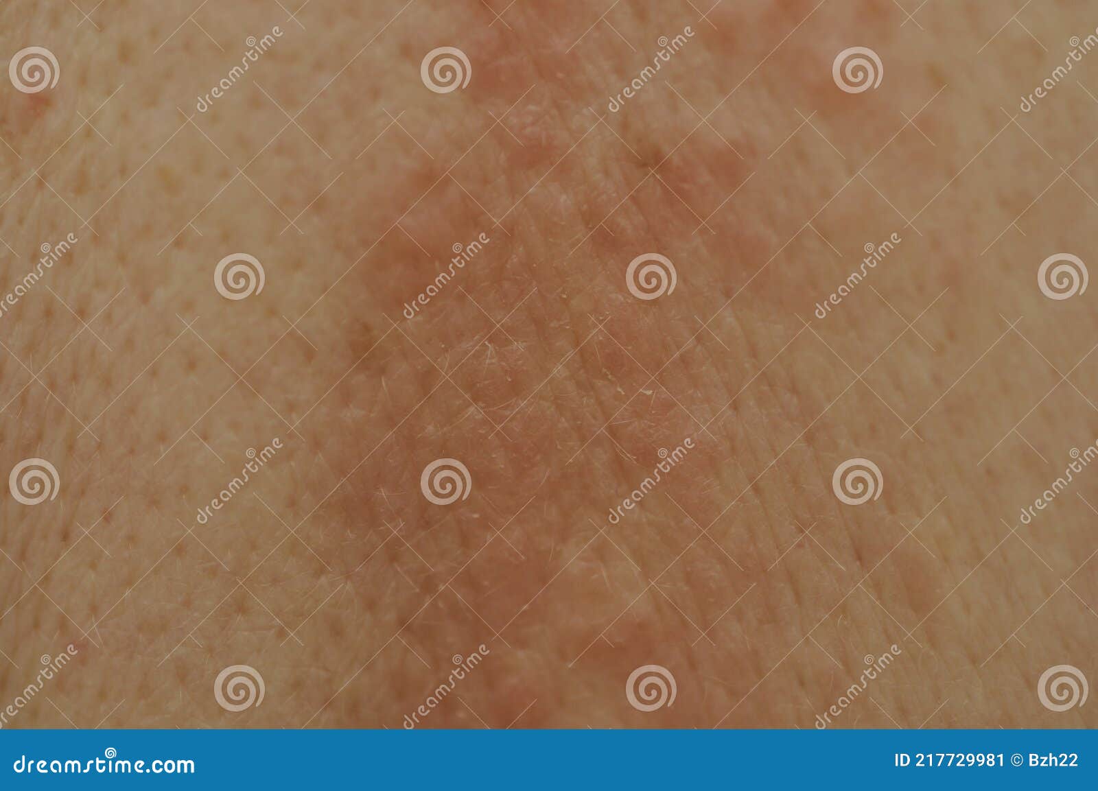 Eczema pimples on a back stock image. Image of dermatologist - 217729981