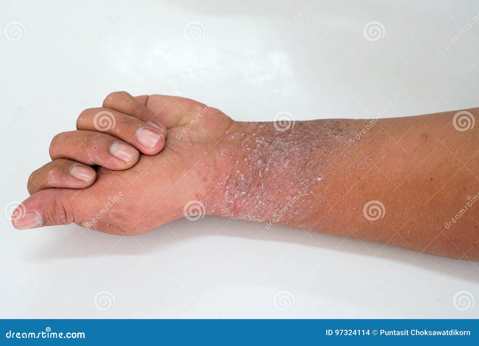 Eczema Presents on the Hand Stock Photo - Image of human, medicine ...