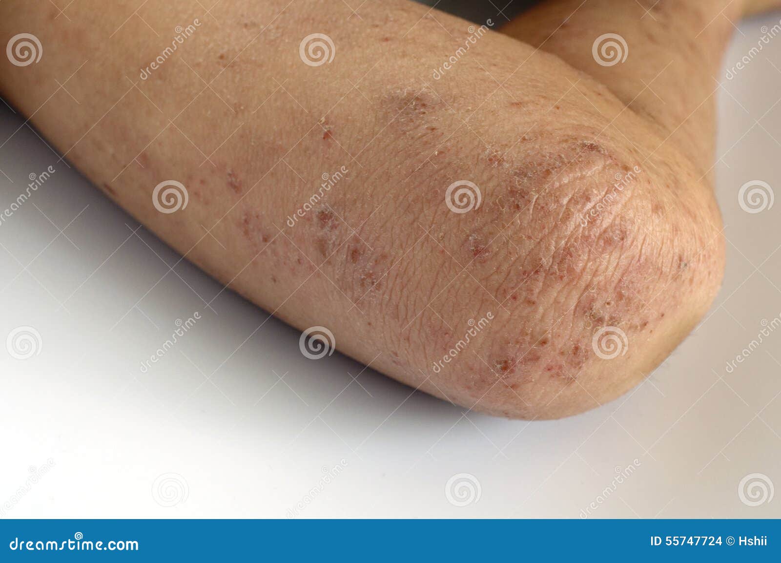 Eczema stock photo. Image of dermatitis, allergy, wound - 55747724